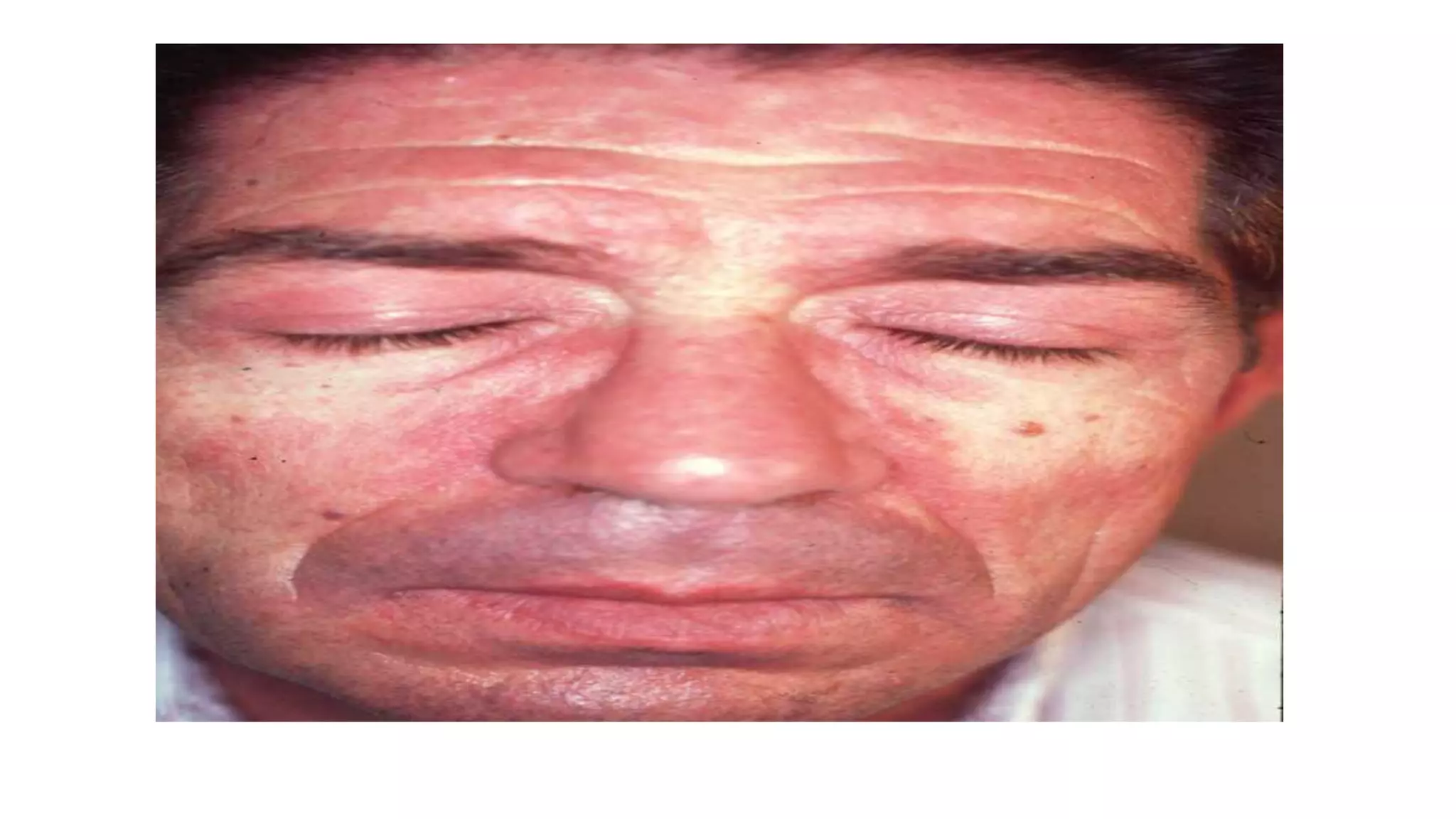 Dermatomyositis PPT | PPTX