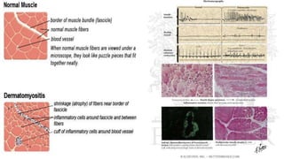 Dermatomyositis PPT | PPTX