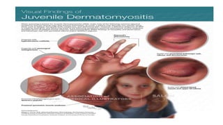 Dermatomyositis PPT | PPTX