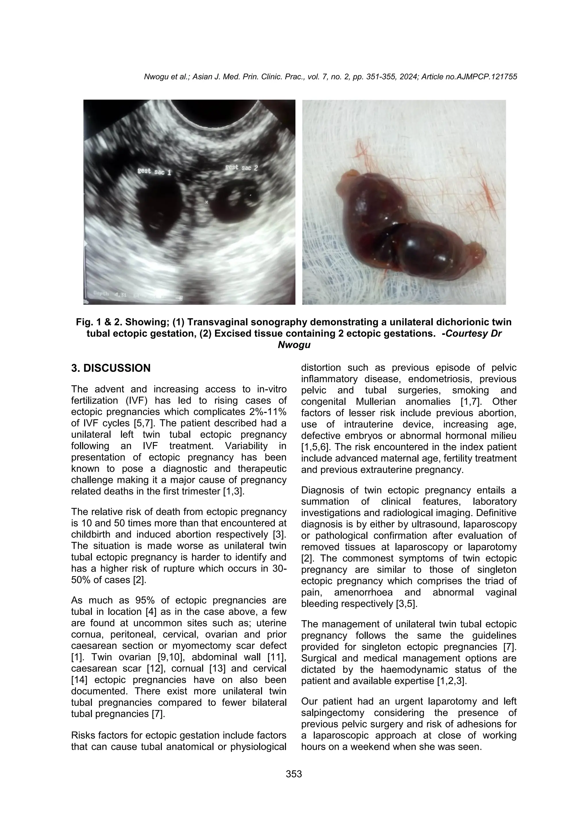 Unilateral Dichorionic Twin Tubal Ectopic Pregnancy Following Fresh In ...