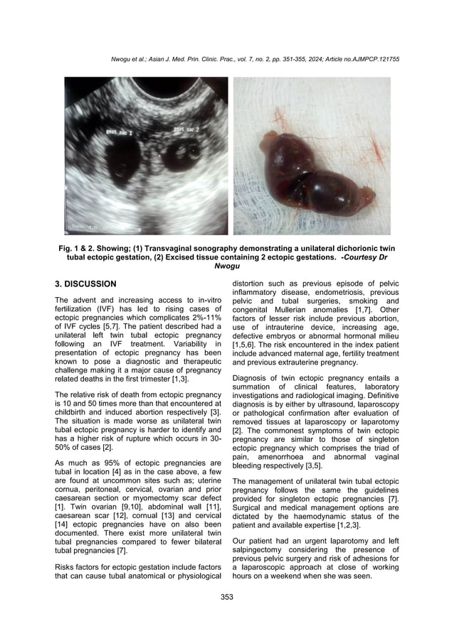 Unilateral Dichorionic Twin Tubal Ectopic Pregnancy Following Fresh In ...
