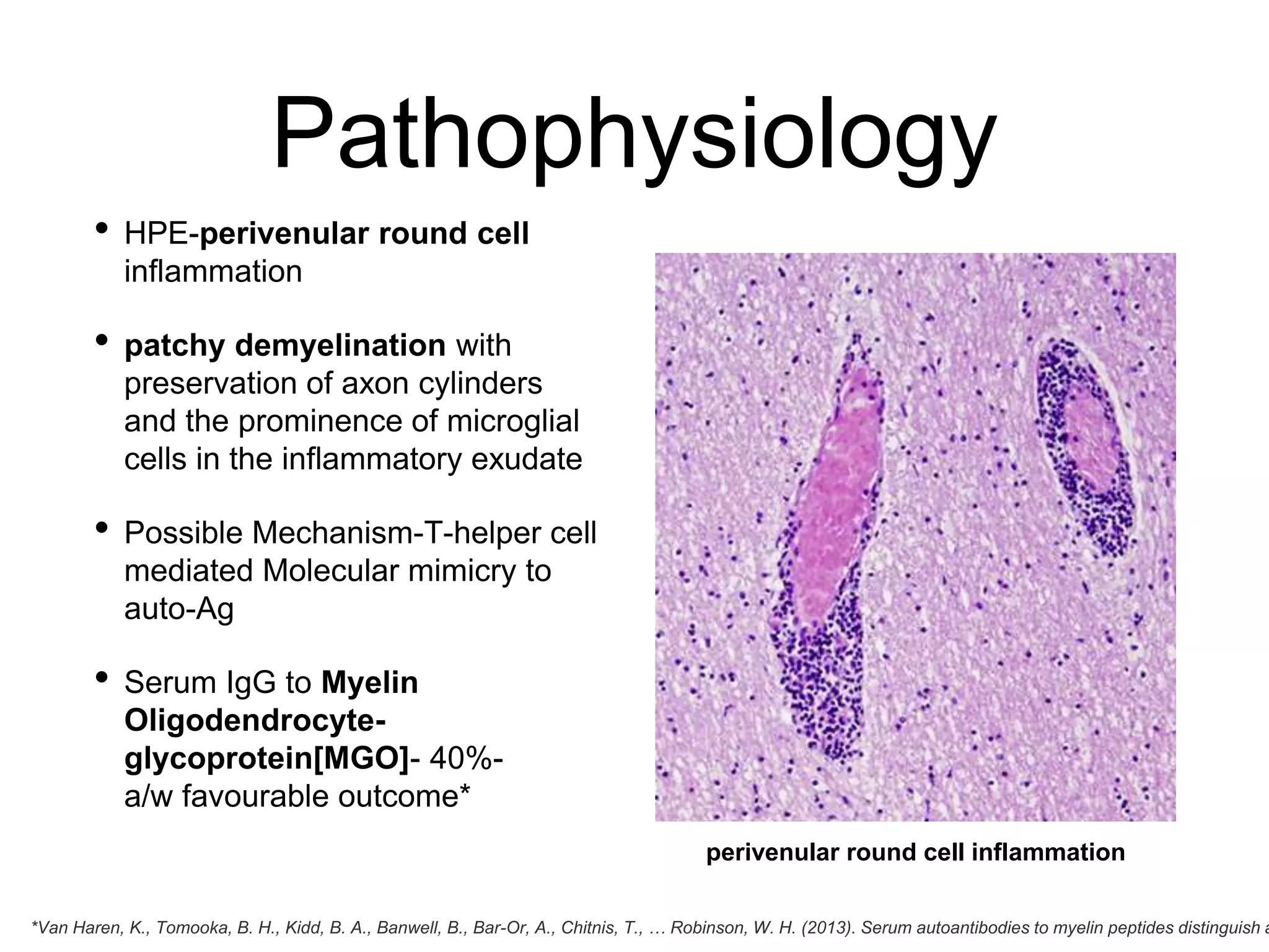 Acute Disseminated Encephalomyelitis | PPTX