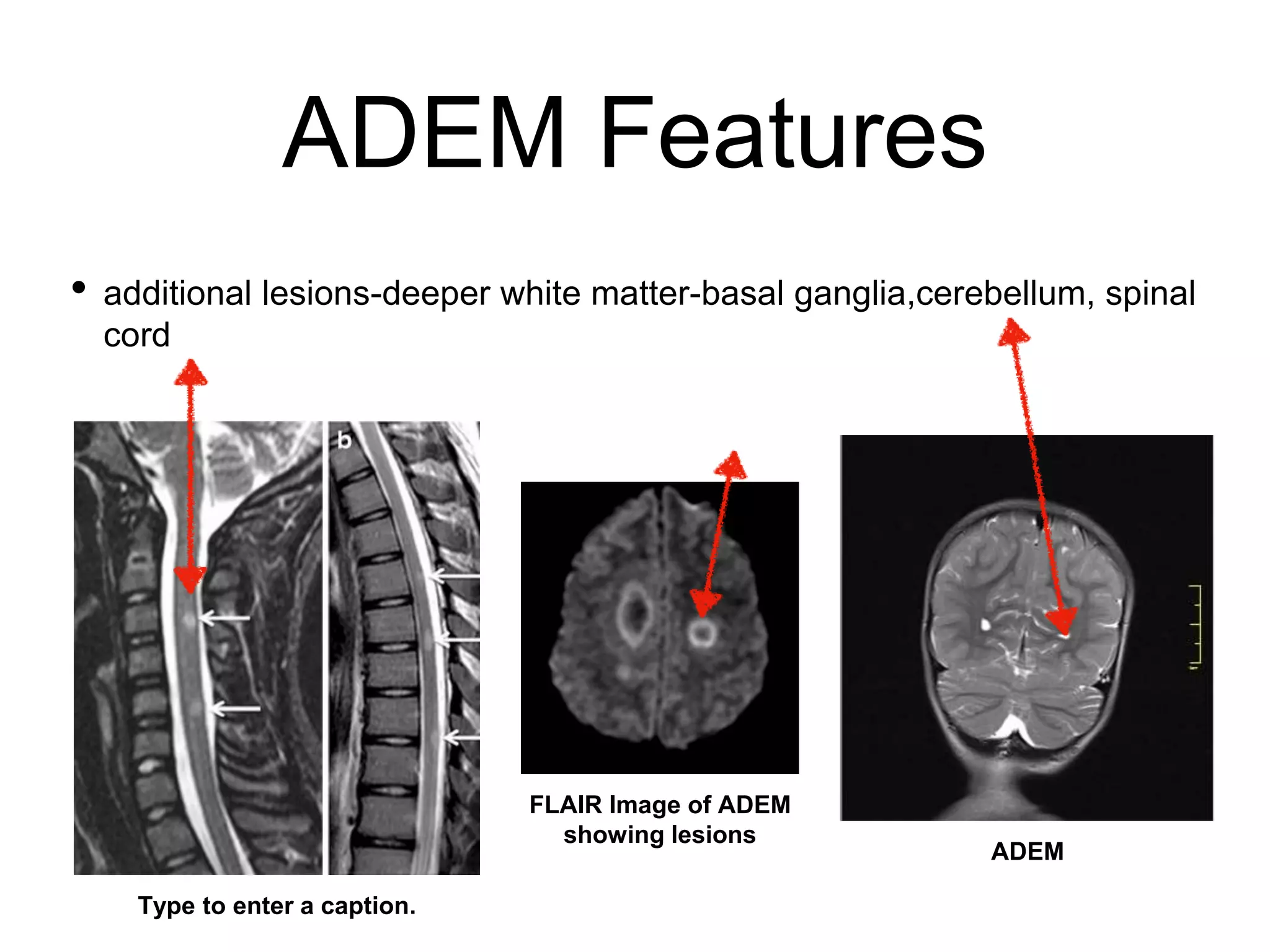 Acute Disseminated Encephalomyelitis | PPTX