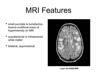Acute Disseminated Encephalomyelitis | PPTX