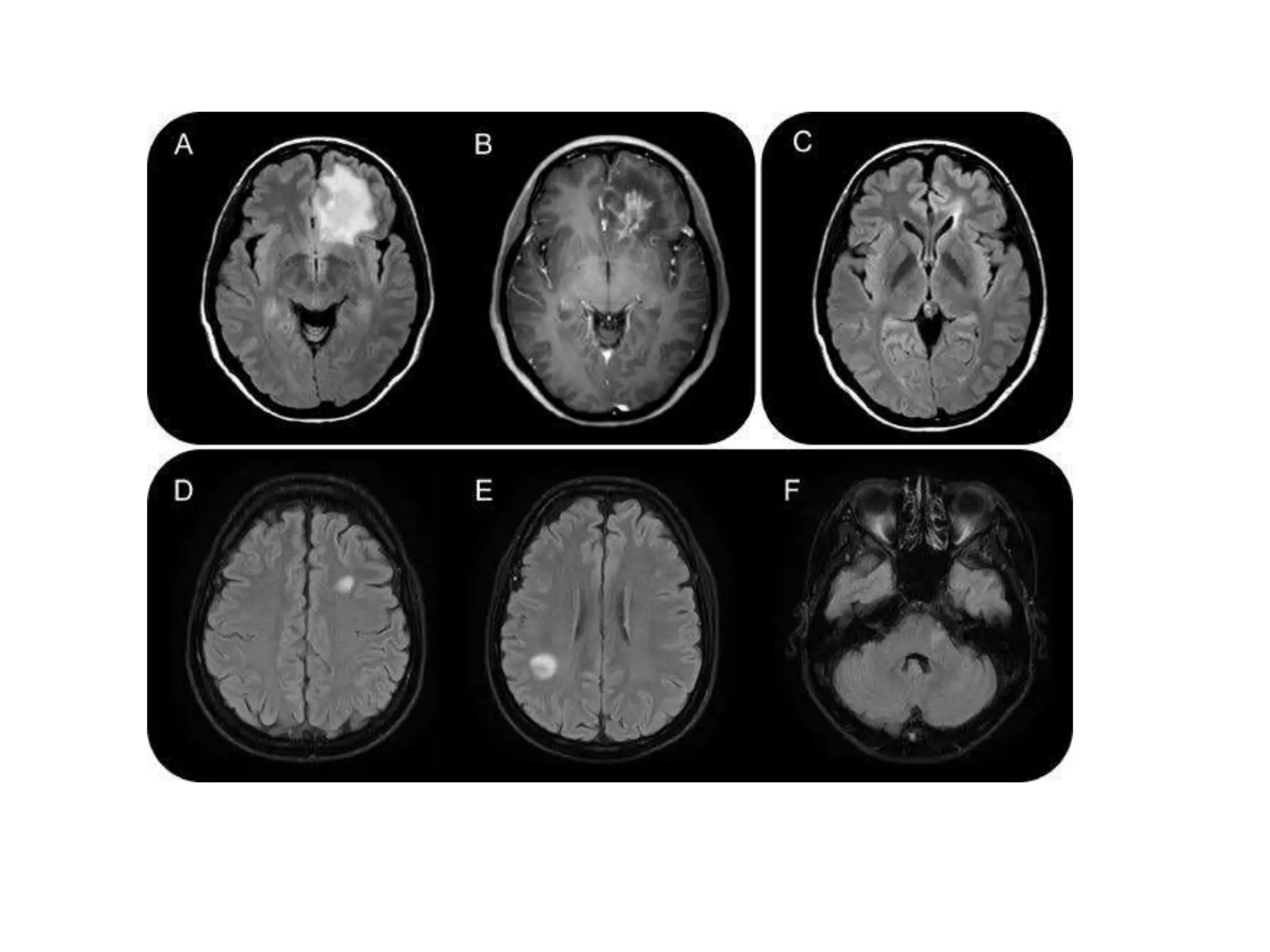 ADEM(Acute Dissiminated Encephalomyelitis) | PPT
