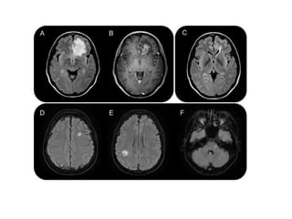 ADEM(Acute Dissiminated Encephalomyelitis) | PPT
