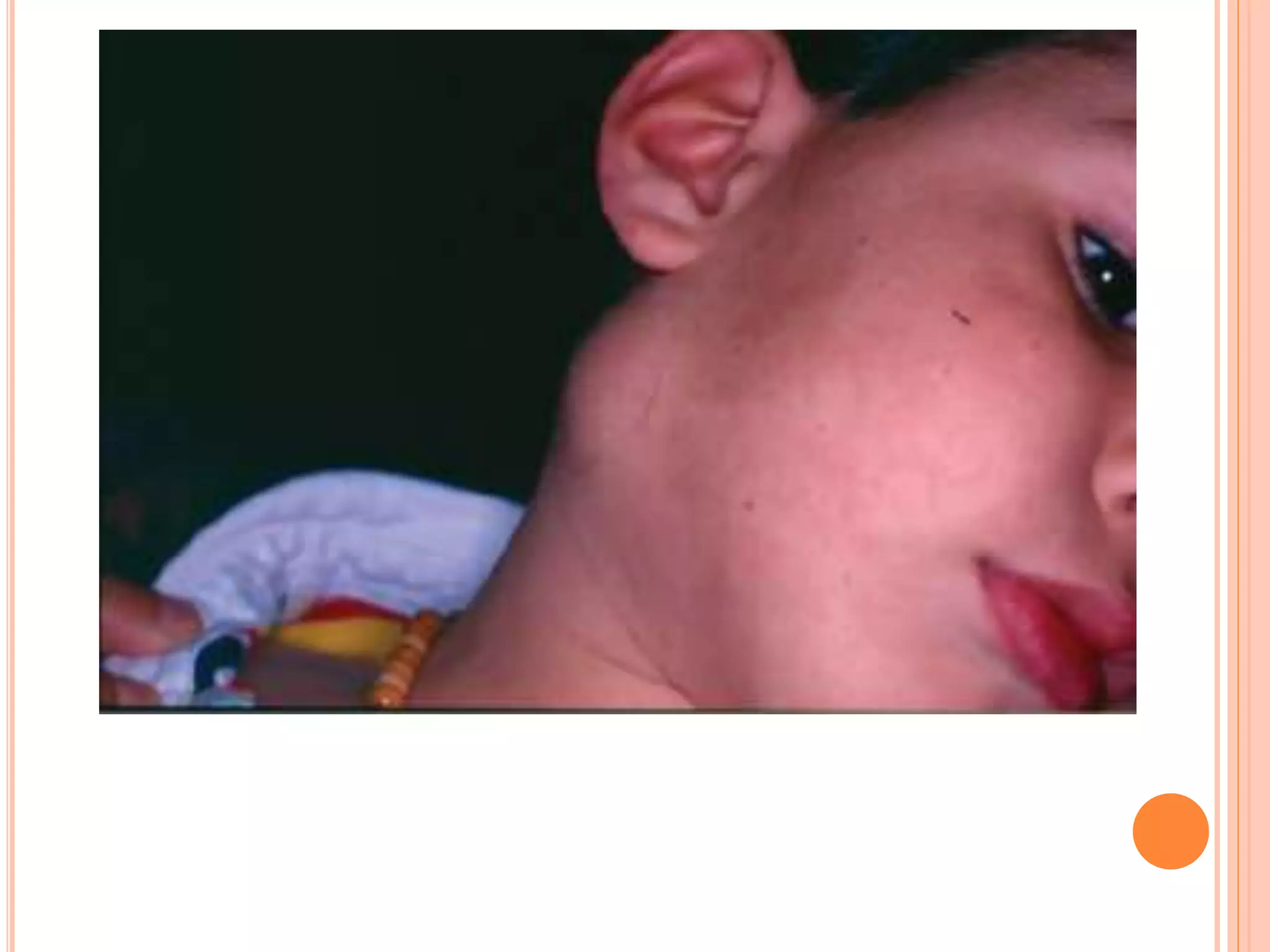 Adenitis cervical | PPT