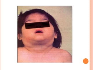 Adenitis cervical | PPTX