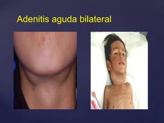 Adenitis Cervical | PPTX