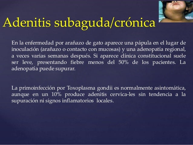 Adenitis Cervical