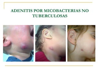 Adenitis crónicas en pediatría | PDF