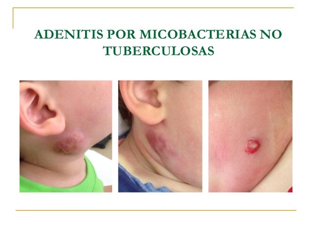 Adenitis crónicas en pediatría