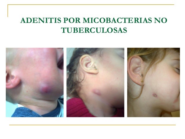 Adenitis crónicas en pediatría