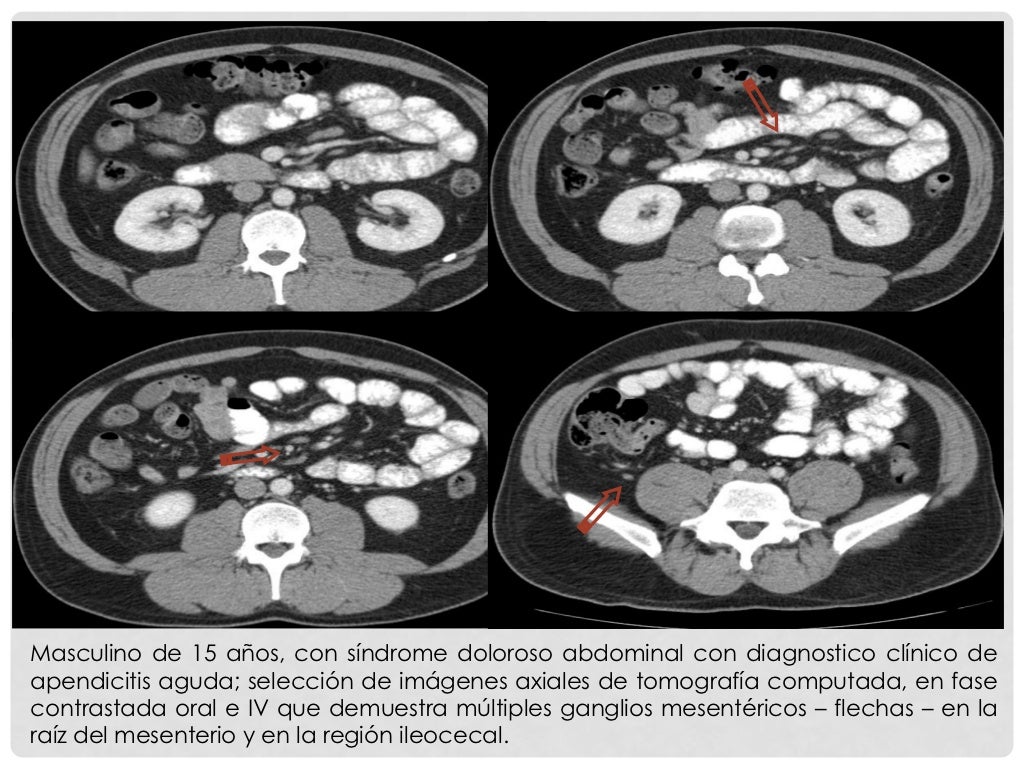 Adenitis Mesenterica