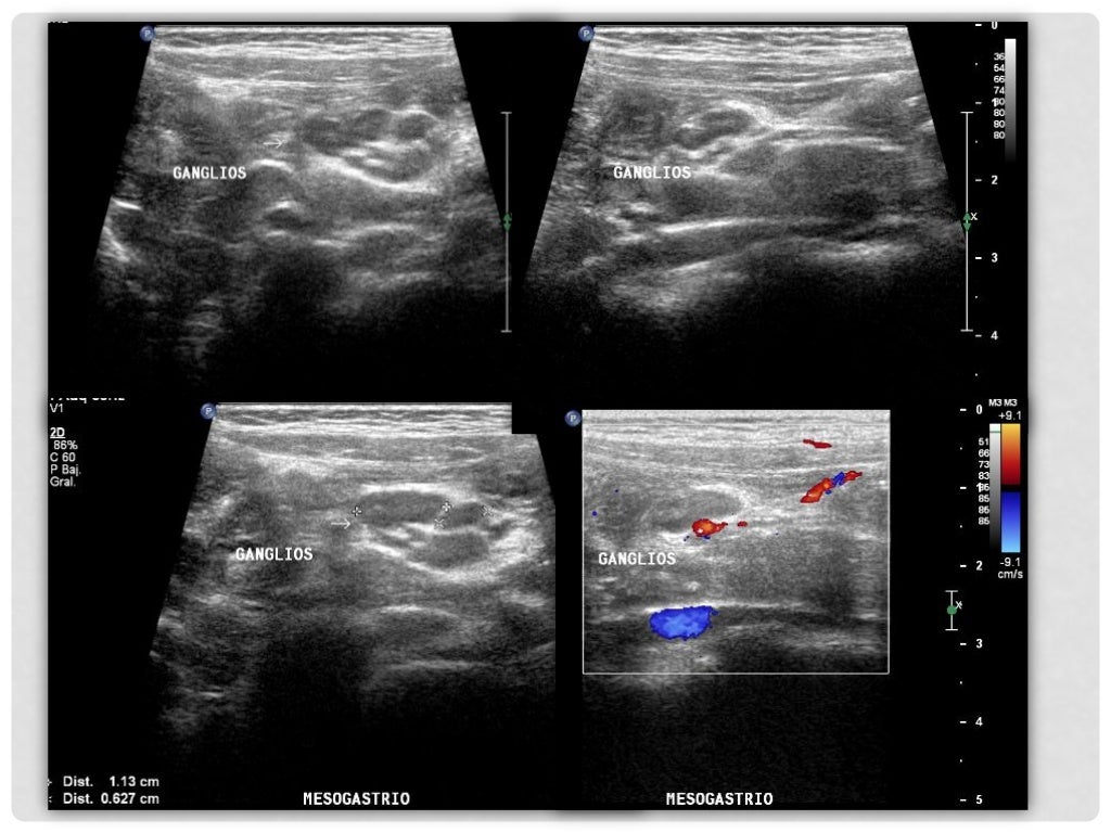 Adenitis Mesenterica