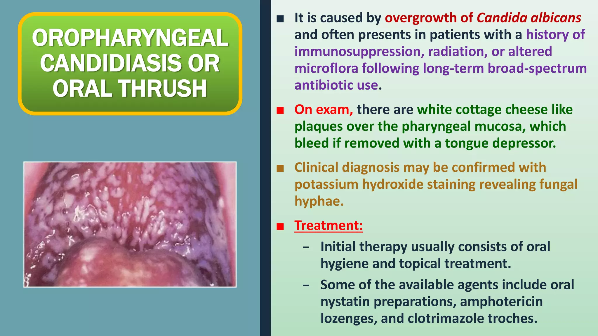 Adeno tonsillar diseases | PPTX