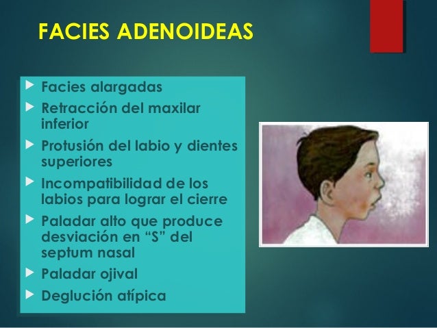ADENOIDECTOMÍA AMIGDALECTOMÍA
