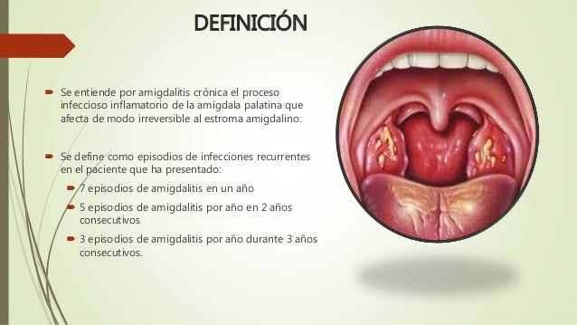 Adenoamigdalitis aguda y cronica