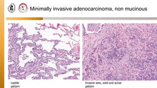 adenocarcinoma pulmo pathology presentation.pptx