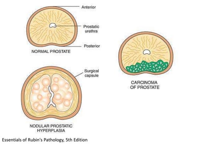 ADENOCARCINOMA DE PROSTATA | PPTX