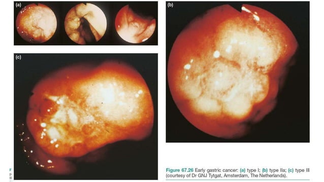 adenocarcinoma of colon & Gastrointestinal track.pptx