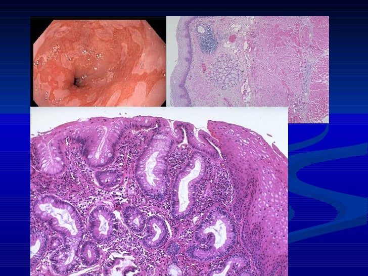 Adenocarcinoma De Esofago Y Endoscopia