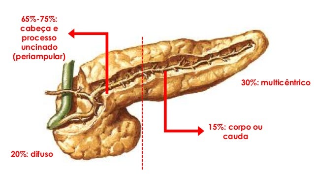 Câncer de Pâncreas