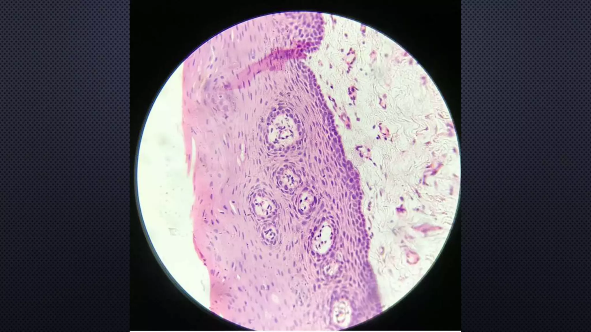 ORAL SUBMUCOUS FIBROSIS | PPTX
