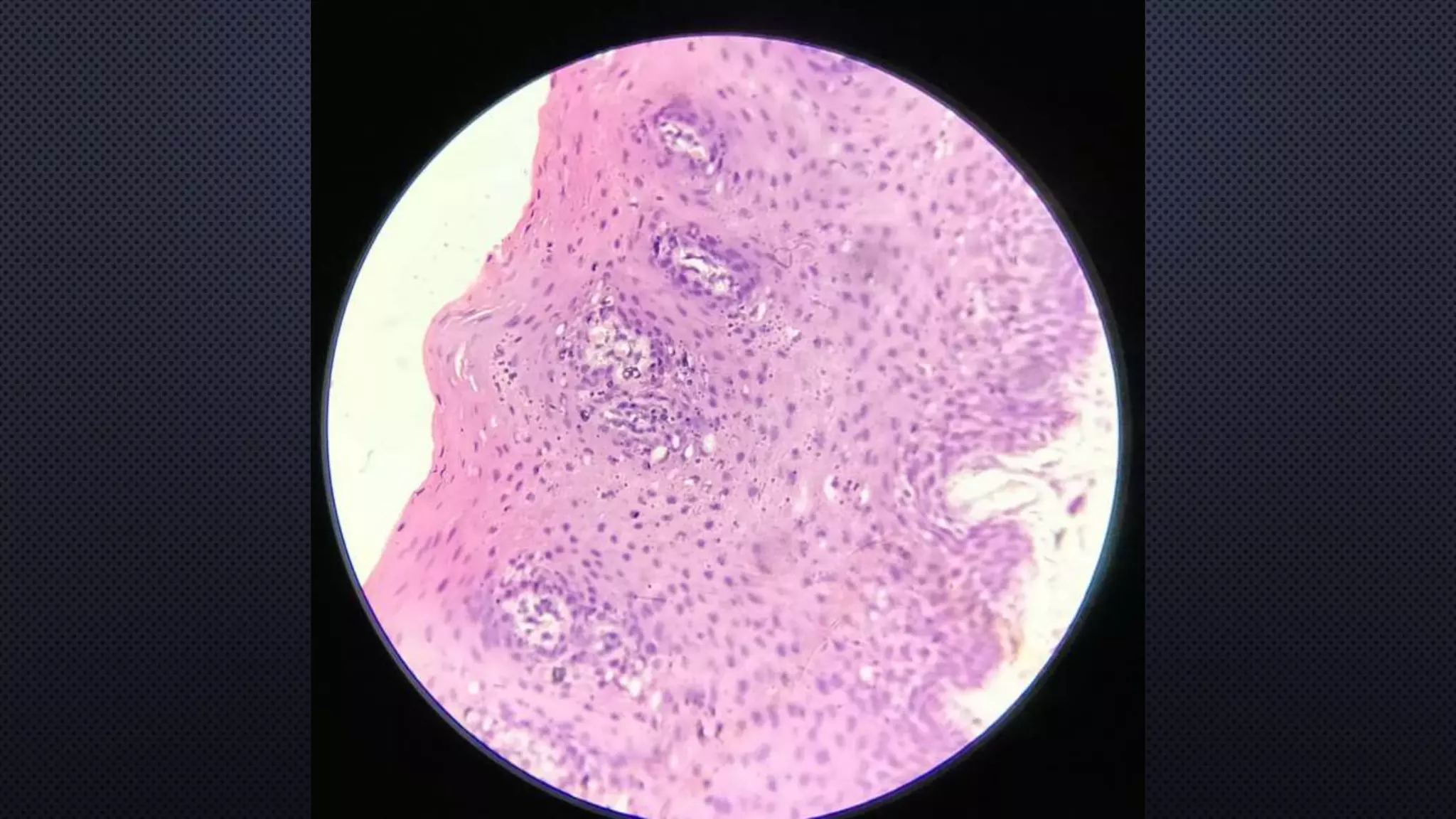 ORAL SUBMUCOUS FIBROSIS | PPTX