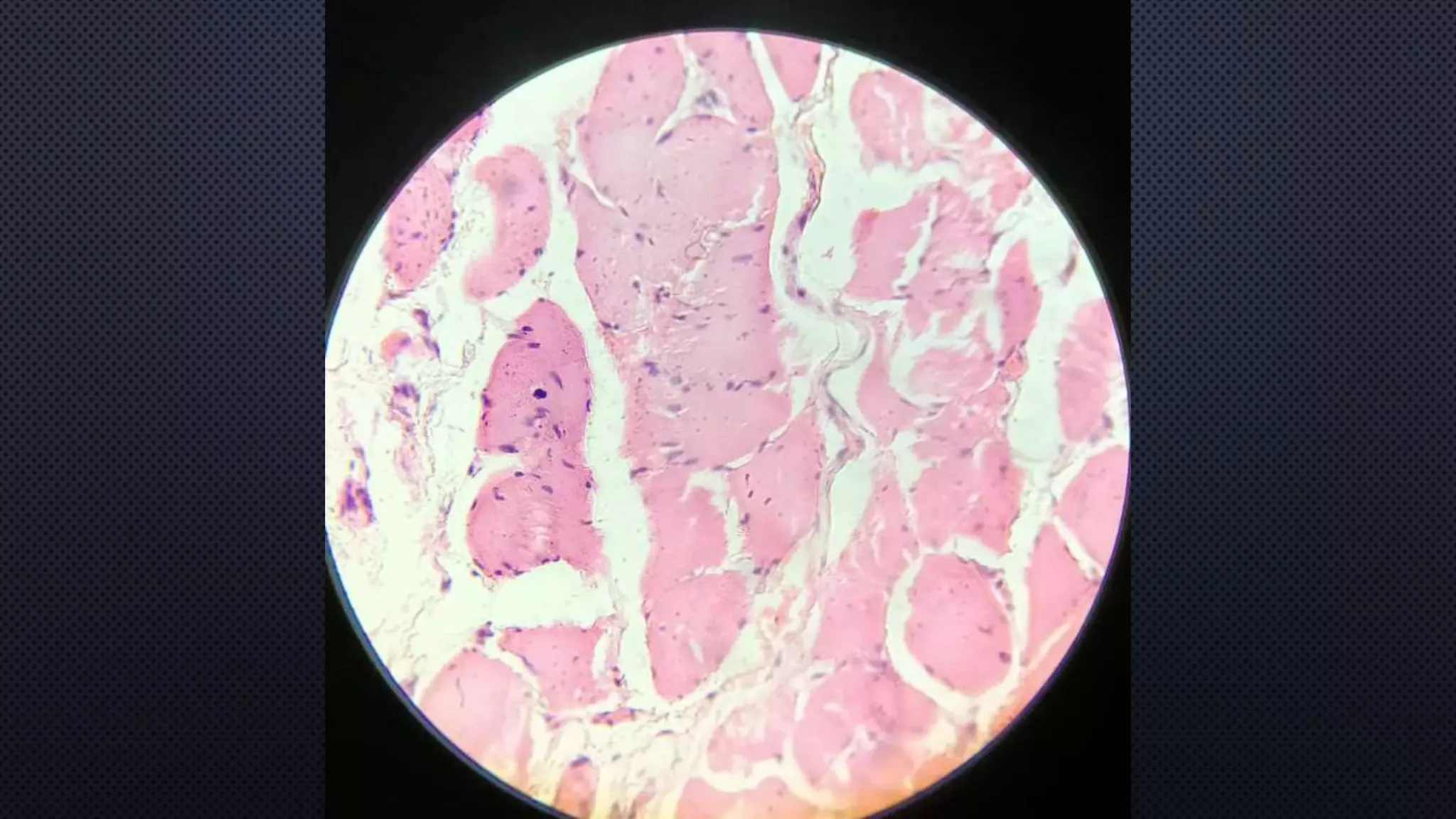 ORAL SUBMUCOUS FIBROSIS | PPTX