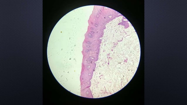 ORAL SUBMUCOUS FIBROSIS | PPTX