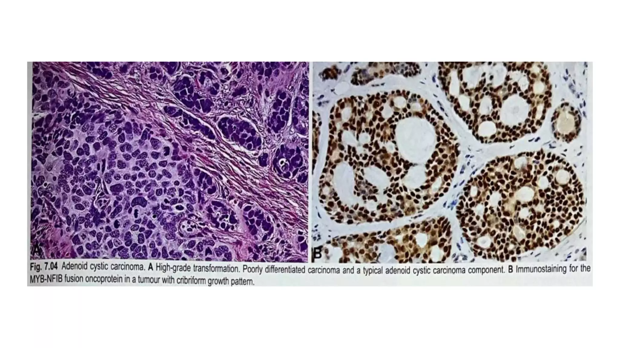 Adenoid cystic carcinoma (Doctor Faris Alabeedi MSc, MMedSc, PgDip, BDS ...