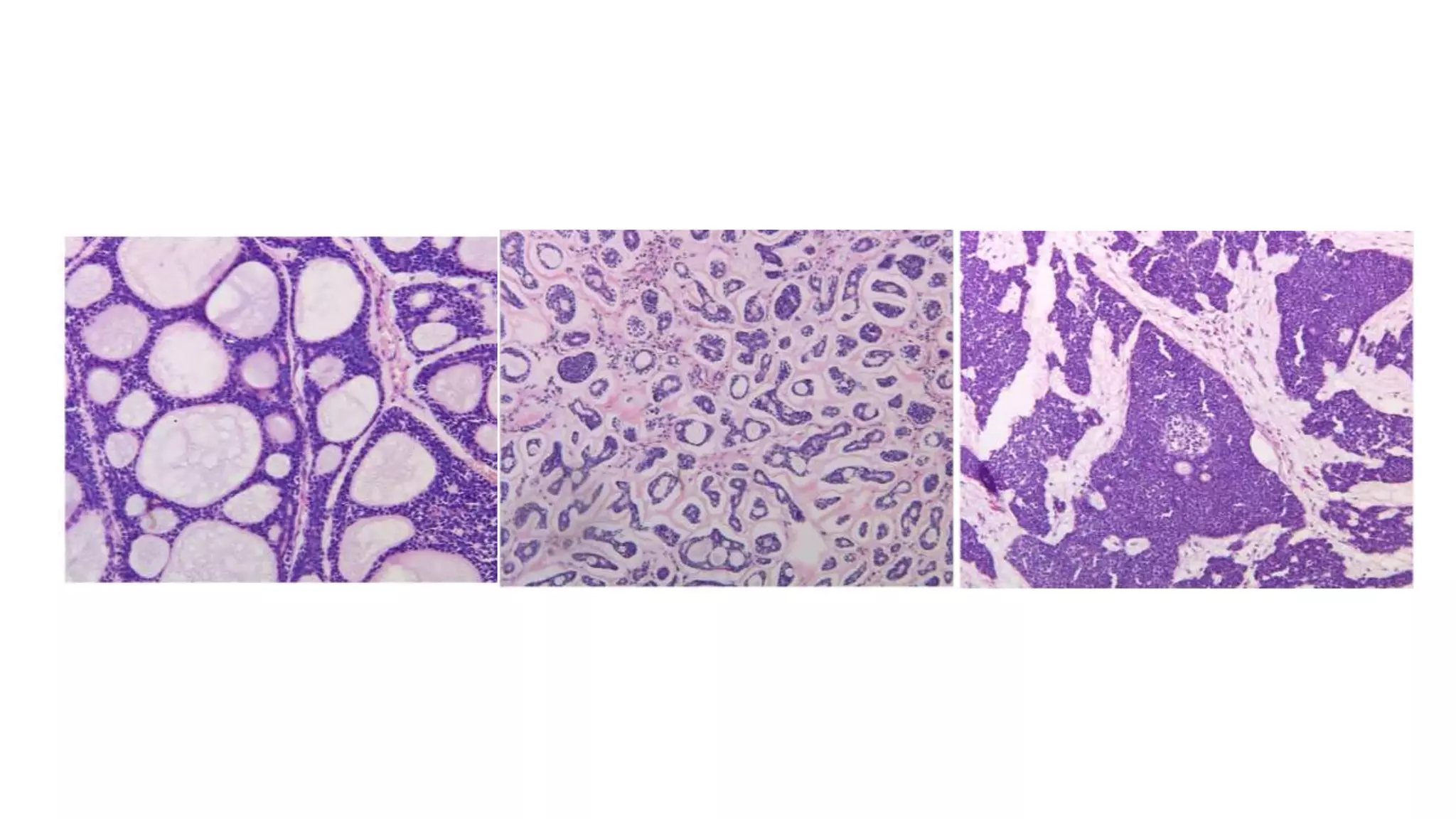 Adenoid Cystic Carcinoma Doctor Faris Alabeedi Msc Mmedsc Pgdip Bds Ppt