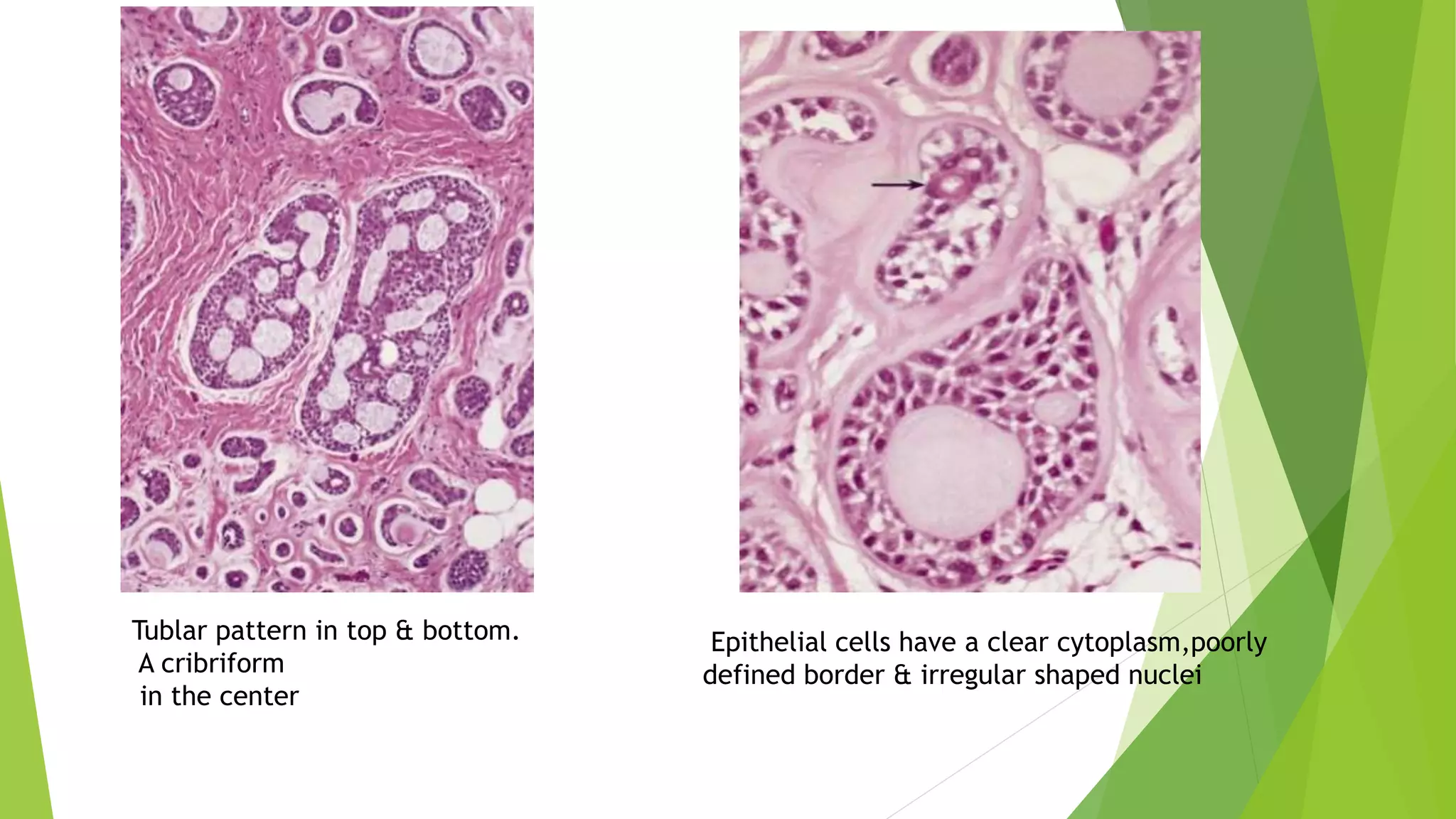 Adenoid cystic carcinoma | PPTX
