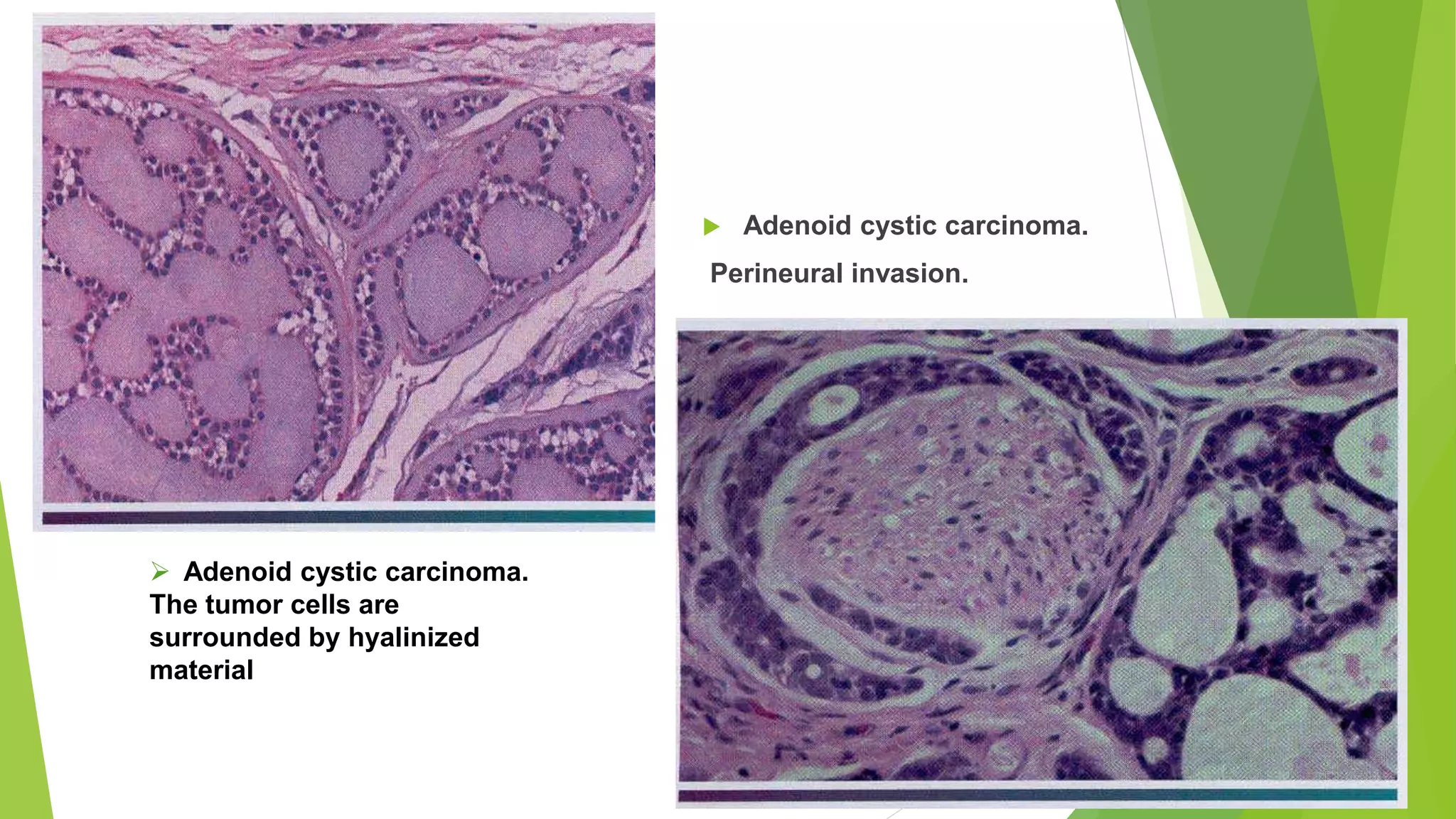 Adenoid cystic carcinoma | PPTX
