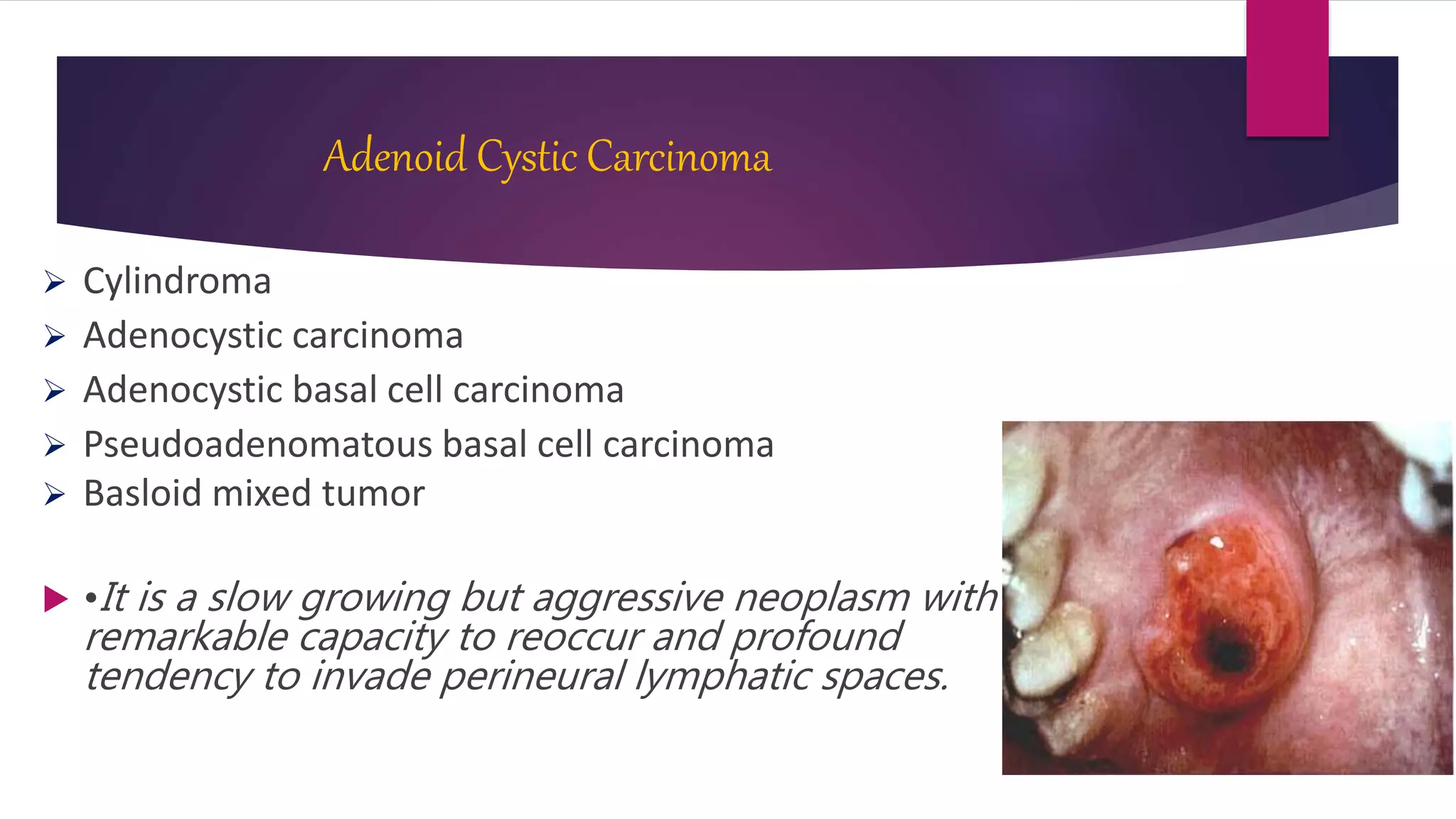 Adenoid Cystic Carcinoma Ppt