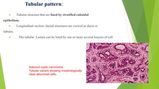 Adenoid cystic carcinoma | PPTX