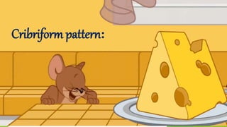 Adenoid cystic carcinoma | PPTX