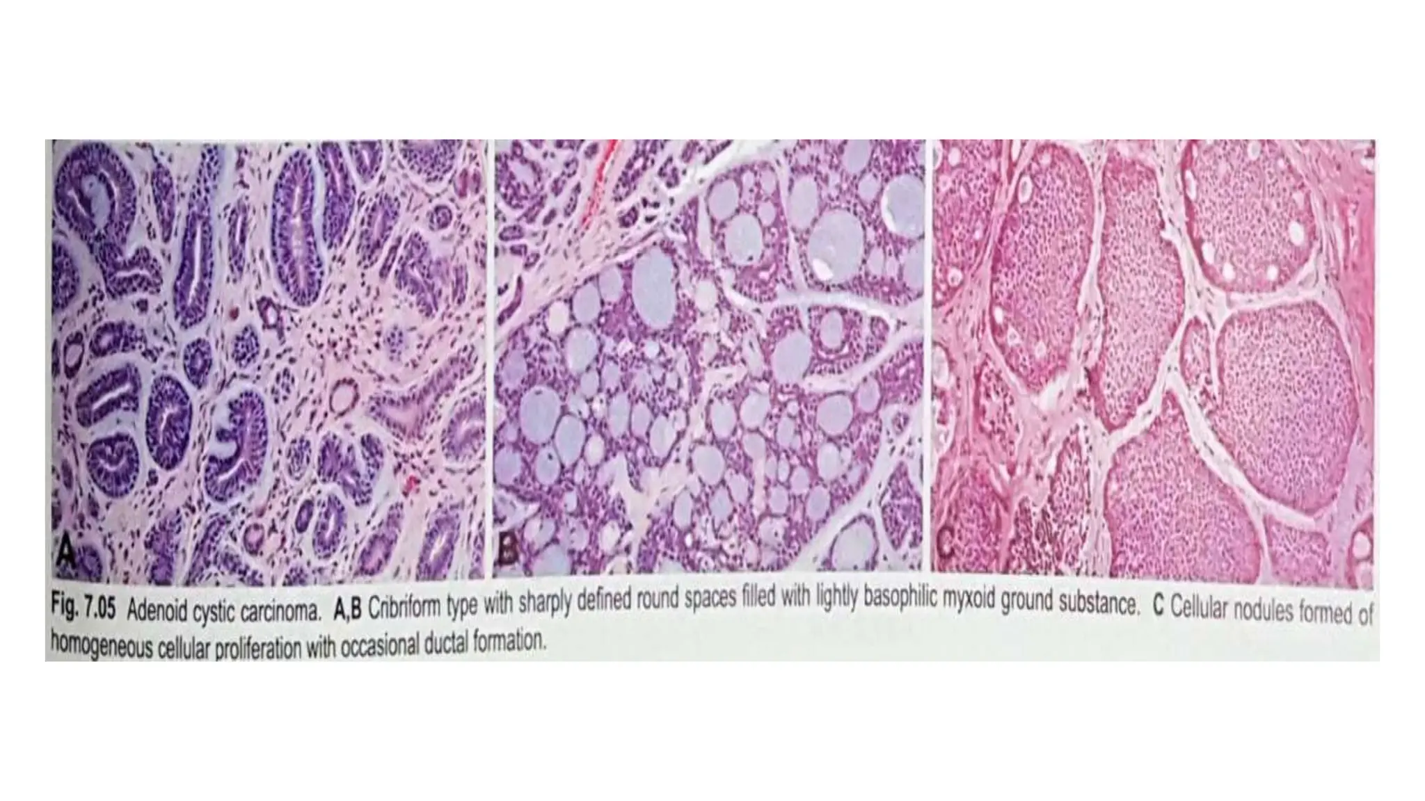 Adenoid cystic carcinoma: salivary gland | PDF