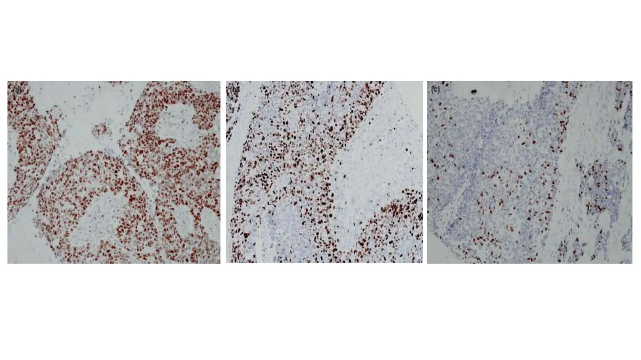 Adenoid cystic carcinoma: salivary gland | PDF
