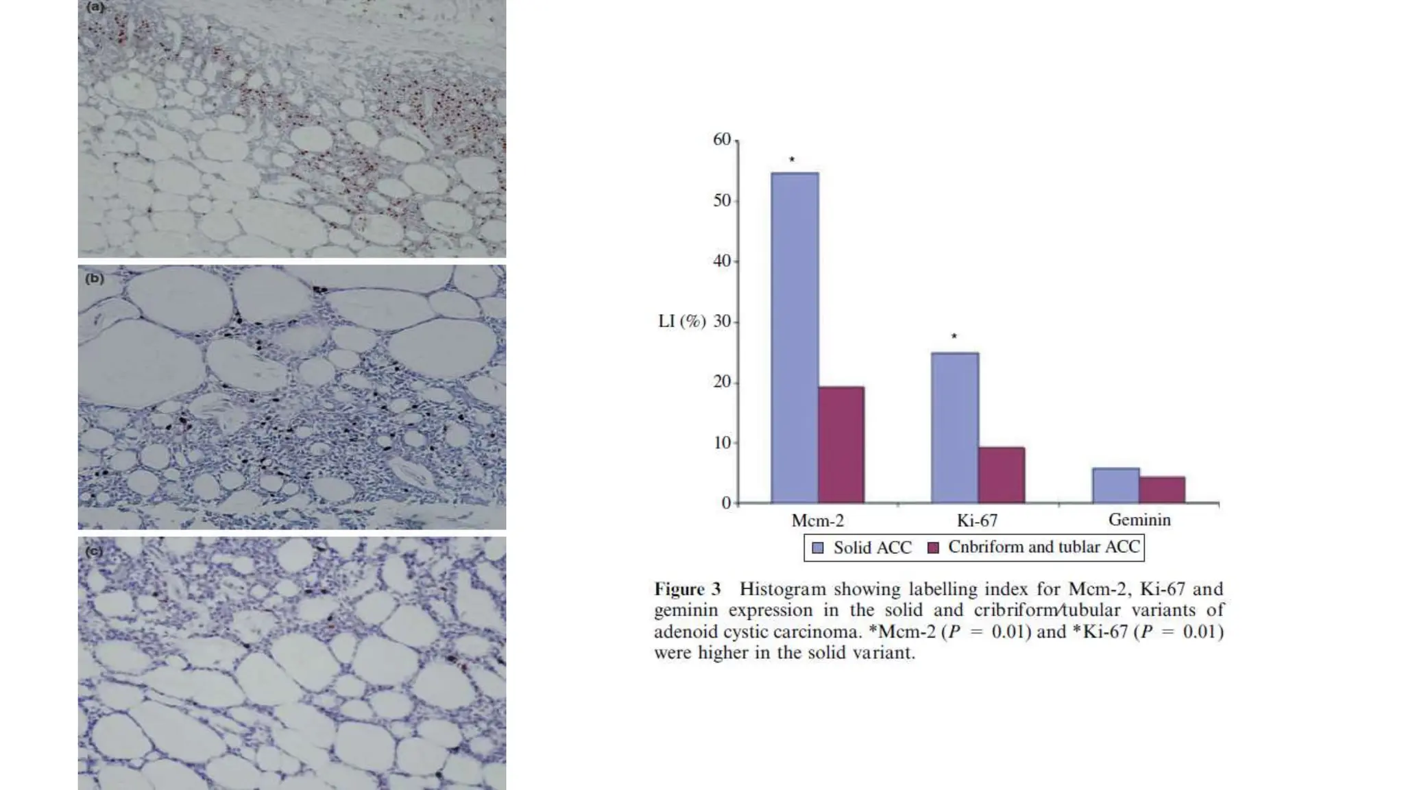 Adenoid cystic carcinoma: salivary gland | PDF