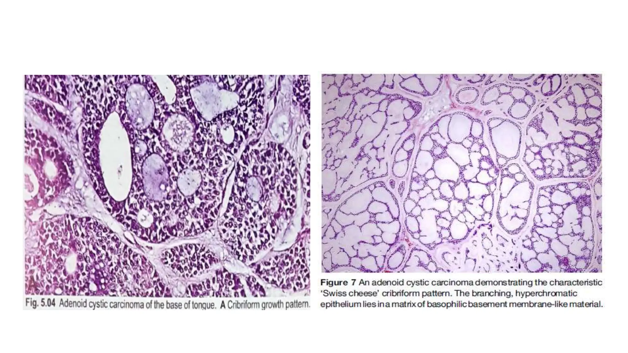 Adenoid cystic carcinoma: salivary gland | PDF