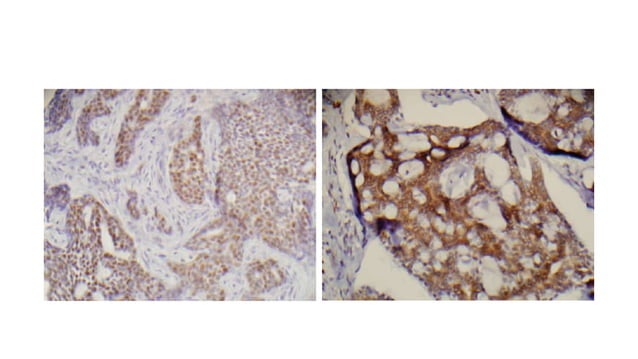 Adenoid cystic carcinoma: salivary gland | PDF
