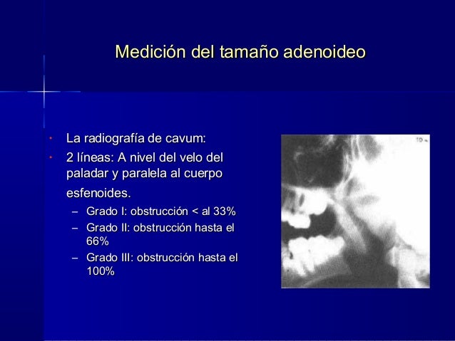 Adenoidectomia con vision endoscopica