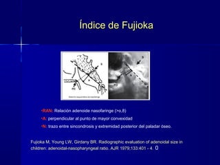 Adenoidectomia con vision endoscopica | PPT