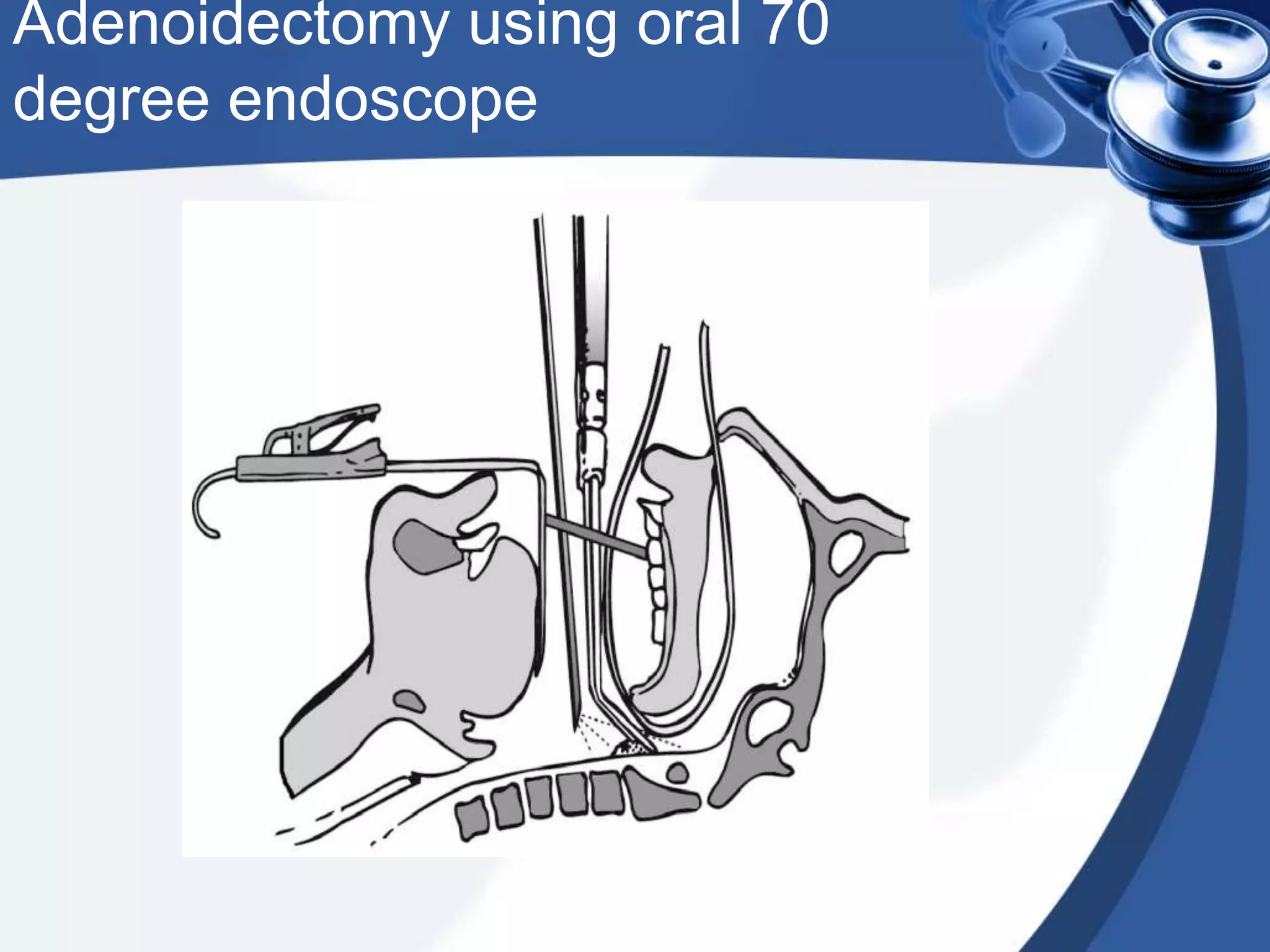 Adenoidectomy | PPTX