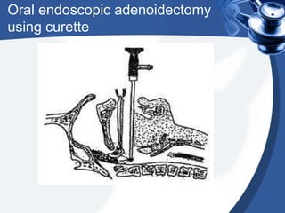 Adenoidectomy | PPTX