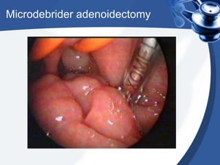 Adenoidectomy Procedure