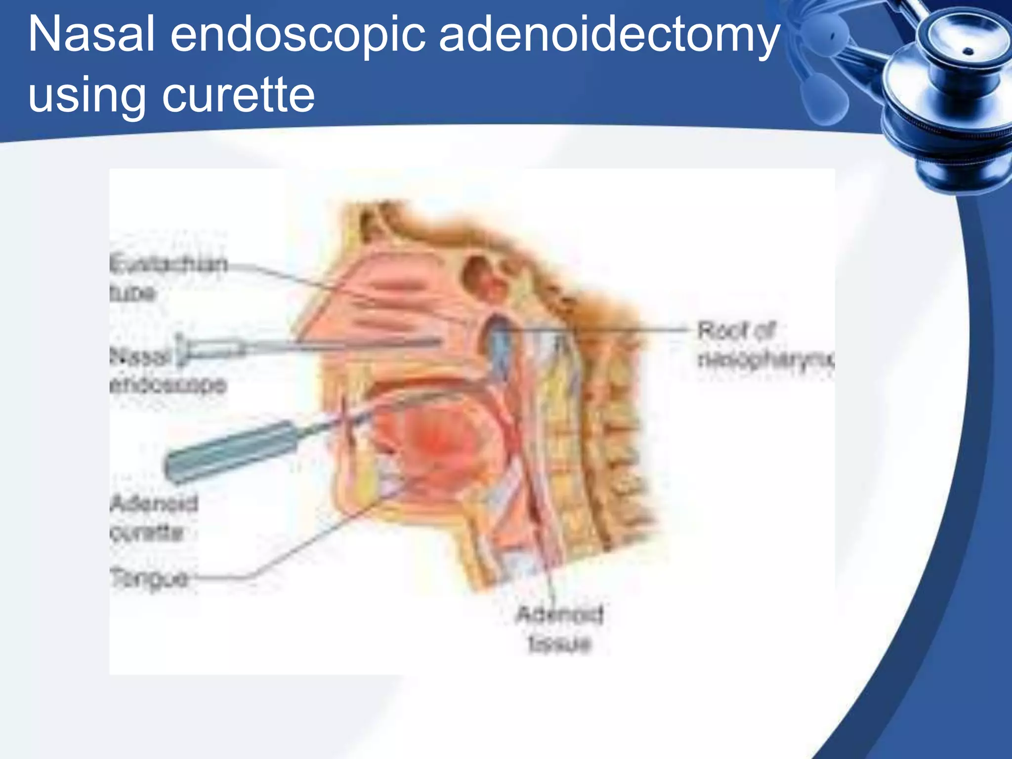 Adenoidectomy | PPTX
