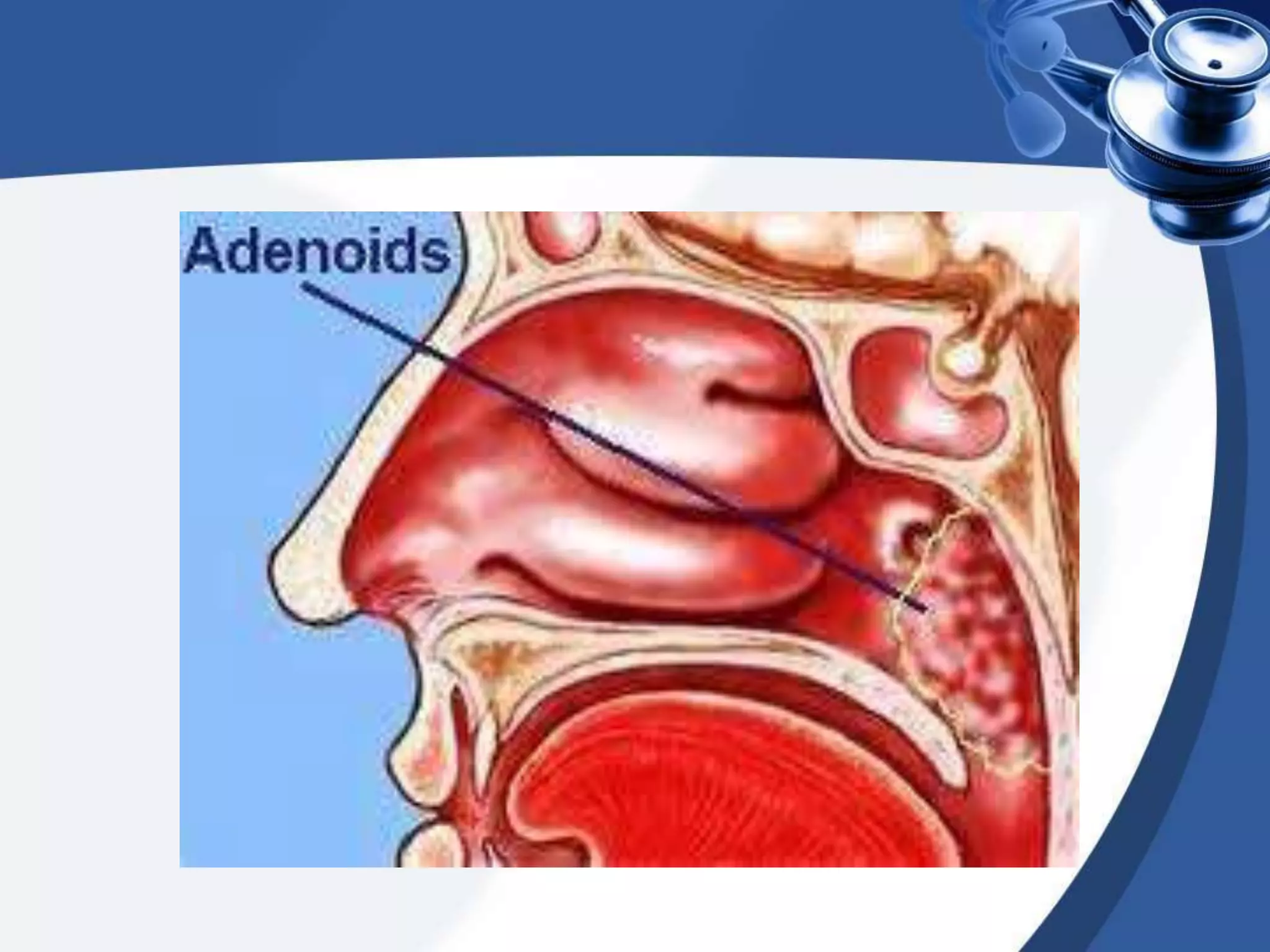 Adenoidectomy | PPTX